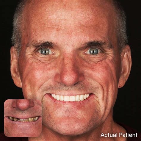 Full Mouth Dental Implants Dallas Tx Doctors Implants