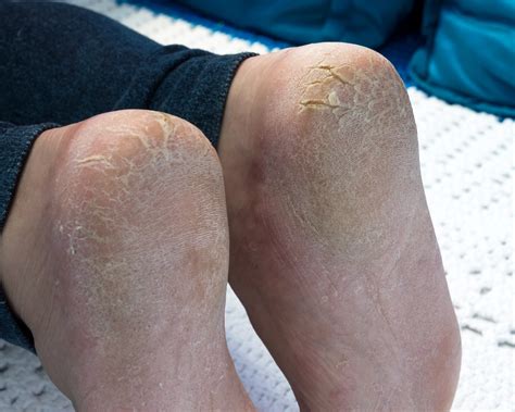 Ichthyosis Causes Treatments Optimists Wellness India