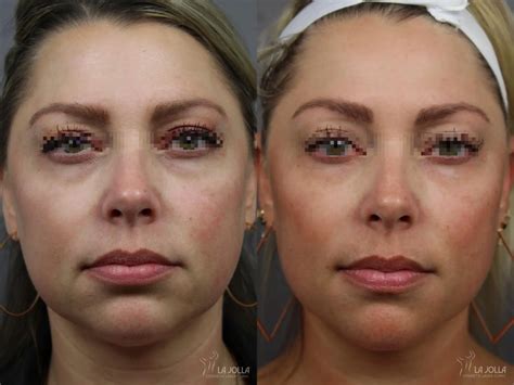 Sculptra® Before And After Gallery