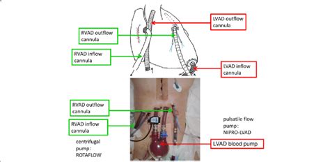 Images After Biventricular Assist Device Implantation We Implanted A