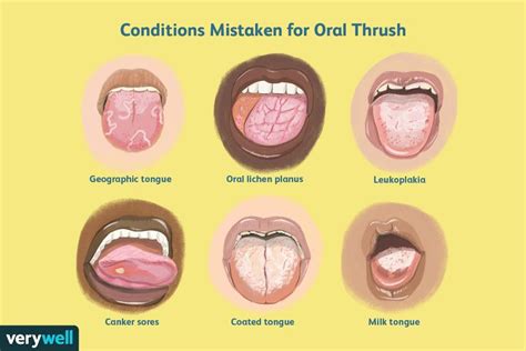 Oral Thrush Vs Normal Tongue And Other Conditions