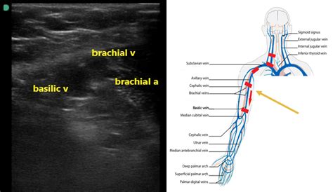 Basilic And Femoral Vein Transposition Thoracic Key