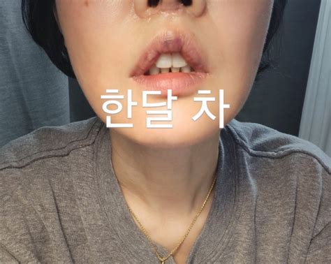 자유수다 인중축소수술후기입니 강남언니 1등 성형수술and피부시술 정보앱