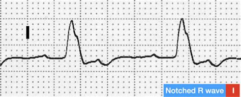 left bundle branch block lbbb litfl ecg library diagnosis