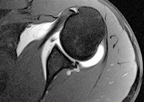 Posterior Labral Tear Shoulder And Elbow Orthobullets