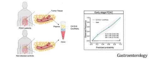 researchers develop circrna based early detection method for pancreatic