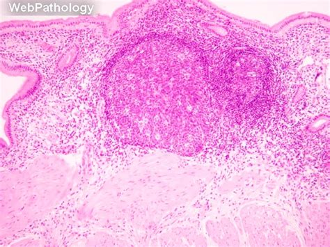 Chronic Calculous Cholecystitis