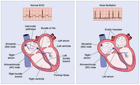 Atrial Fibrillation The Basics Cardiocare