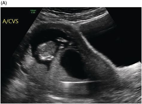 Octuplet Ultrasound