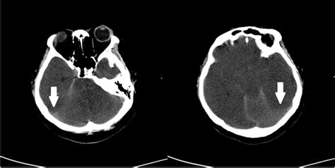 On The Fifth Day Of Admissionct Of The Head Showed That Diffuse