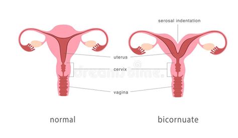 Bicornuate And Normal Human Uterus Structure Uterine Deep Septum As A
