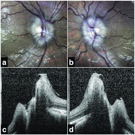 A And B Fundus Photograph Showing Papilledema Of Right Od And Left