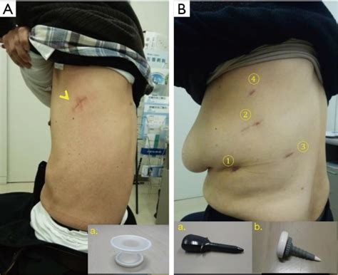 Uniportal Video Assisted Thoracic Surgery Reduced The Occurrence Of