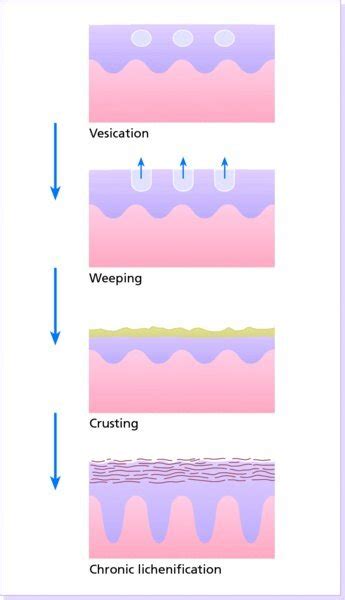 Lichenification Eczema