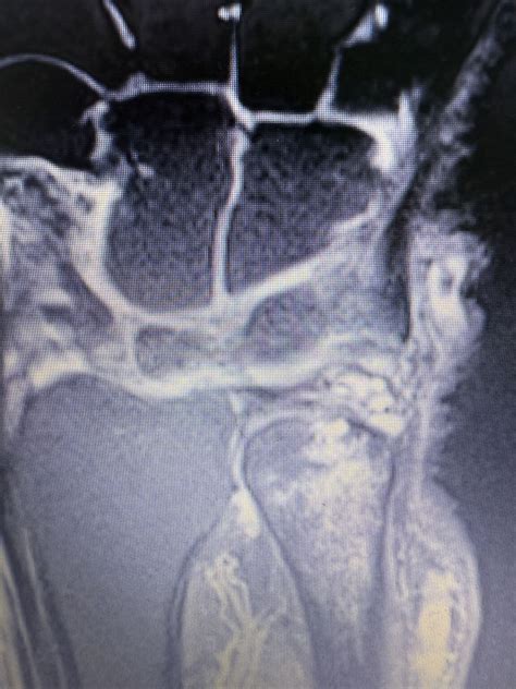 Patient With Tfcc Tear Ulnar Carpal Joint Oa Basically Ulnar