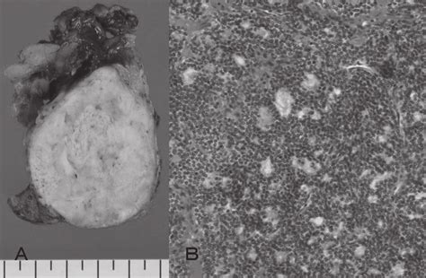 A A Macroscopic View Of The Tumor The Thymic Tumor Had Well Defined