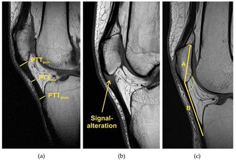 Mri Characteristics And Alterations In Patellar Height In Patients With