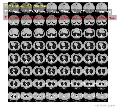 Mosmeddata 新冠肺炎胸部 Ct扫描数据集上基于3d Cnn实现二分类3d医学影像二分类网络 Csdn博客