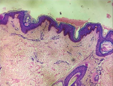 Dermatopathia Pigmentosa Reticularis Pmc