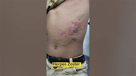 Herpes Zoster Shingles 👆🏻🔥🤯 Note Dermatomal Pattern Doctor