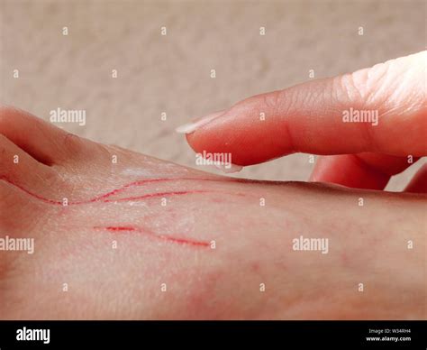 Skin Scratch Marks