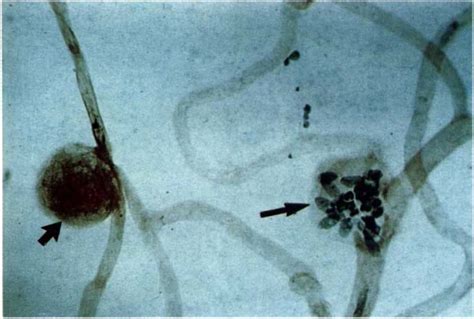 Trypsin Digest Preparation Of Human Diabetic Retina Showing Acellular