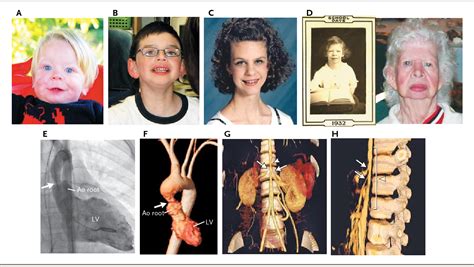 Sinotubular Junction Semantic Scholar