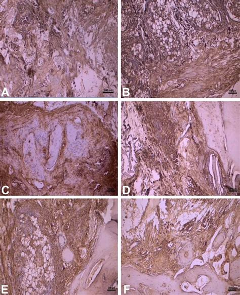 A Defect Group Positive Osteonectin Expression In Inflammatory Cells Download Scientific