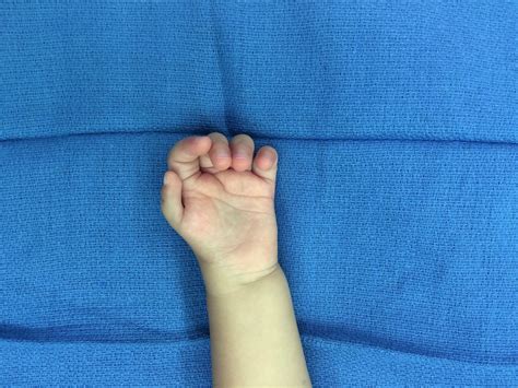 Pollicization Concerns Immediately After Surgery Congenital Hand And