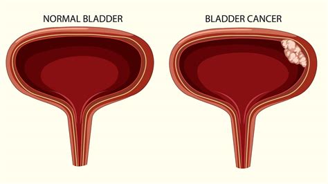 Symptoms Treatment And Prevention Of Bladder Cancer In Women Onlymyhealth