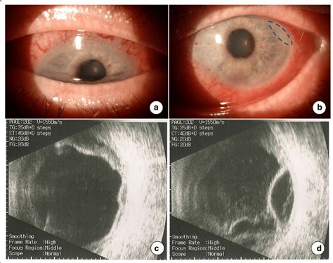 Examination At Presentation Diffuse Scleritis Mild Paralimbal