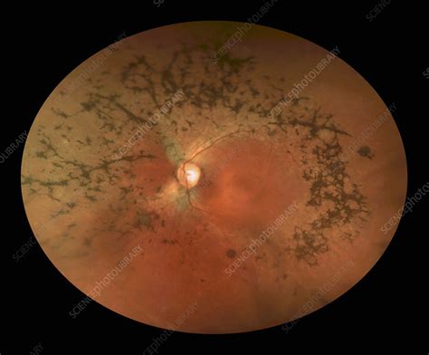 Bone Spicules Stock Image C0306957 Science Photo Library