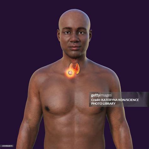 Thyroid Cancer Illustration High Res Vector Graphic Getty Images