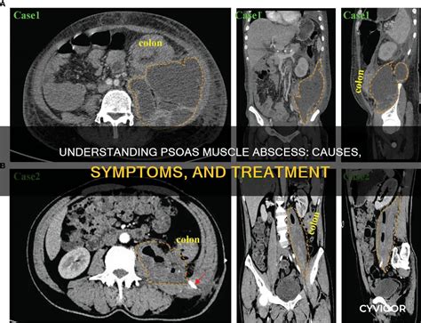 Understanding Psoas Muscle Abscess Causes Symptoms And Treatment