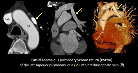 Papvr Papvr Cardiovascularimaging Congenitalheartdisease Yescct