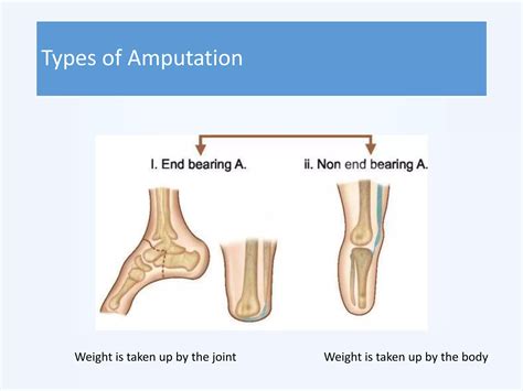 Amputation And Disarticulation Pptx