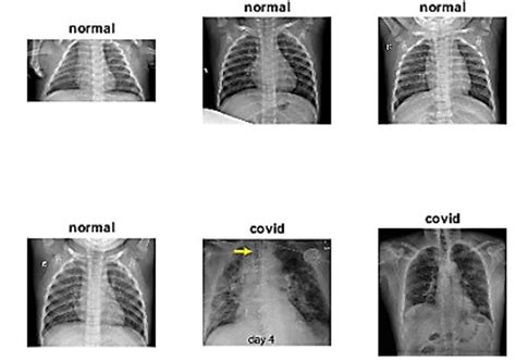 Deep Learning Model For Detecting COVID On Chest X Ray Using MATLAB Algorithm