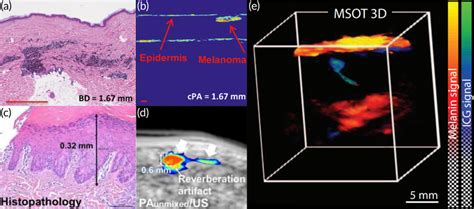 Photoacoustic Computed Tomography Pact Imaging Of Melanoma Ab Download Scientific Diagram