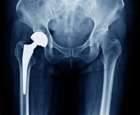 Anterior Vs Posterior Which Hip Replacement Is Right For You The