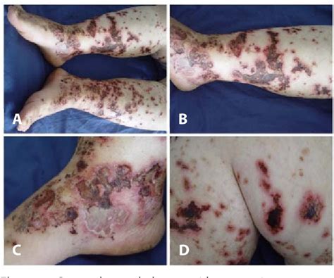 Figure 1 From Ulcerative Iga Vasculitis In The Setting Of Warfarin Therapy Semantic Scholar