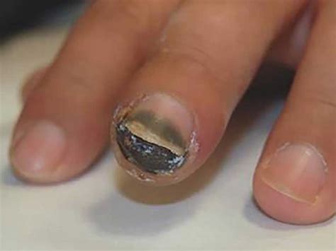 Spot Dx — Whats Behind This Black Finger Ausdoc