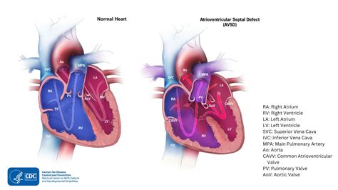 Atrioventricular Septal Defect Avsd Congenital Heart Defects Chds
