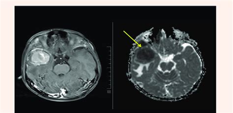 Lymphoma Right Temporal Mass Lesion Showing Intense Enhancement And