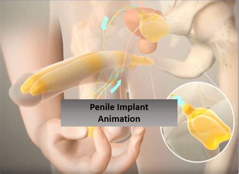 Penile Implants For Erectile Dysfunction Au