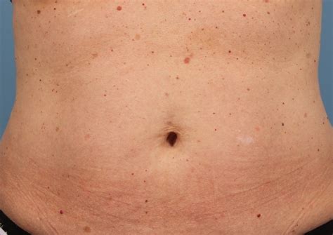 Cherry Angioma Removal