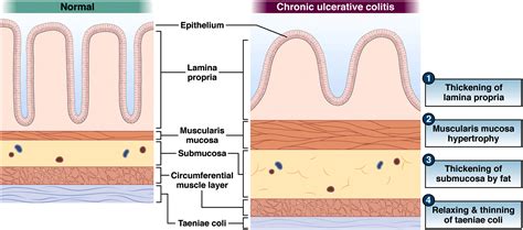 What Does Disease Progression Look Like In Ulcerative Colitis And How