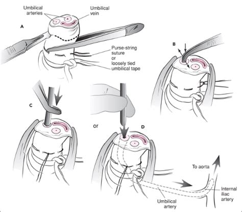 Umbilical Vessel Catheterization Obgyn Key