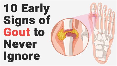10 Early Signs Of Gout To Never Ignore