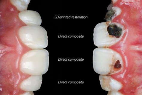 3d Printed Crown And Direct Composite Restorations In Anterior Teeth