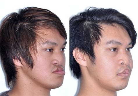 Case 19 Cleft Upper And Lower Jaw Surgery Sydney Oral And Facial Surgery